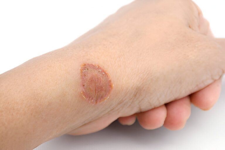 Rashes That Look Like Ringworm But Aren't: Causes